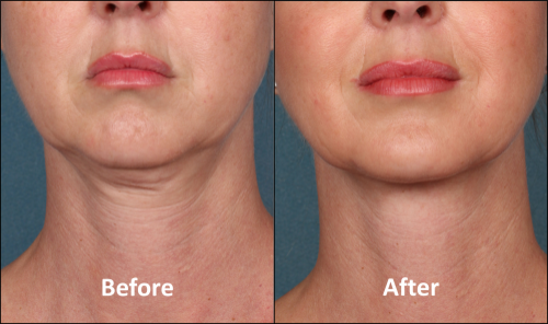 Nefertiti Neck Lift (Botox Injection) - Hidden Springs Wellness & Med Spa